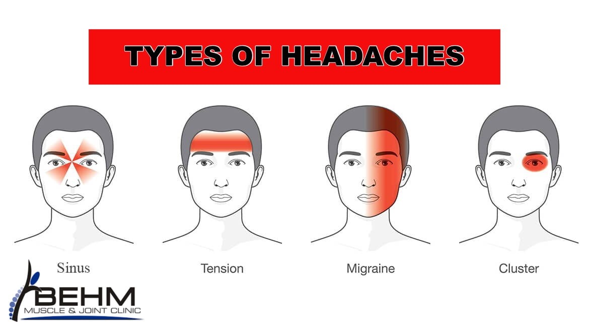 Types Of Headaches